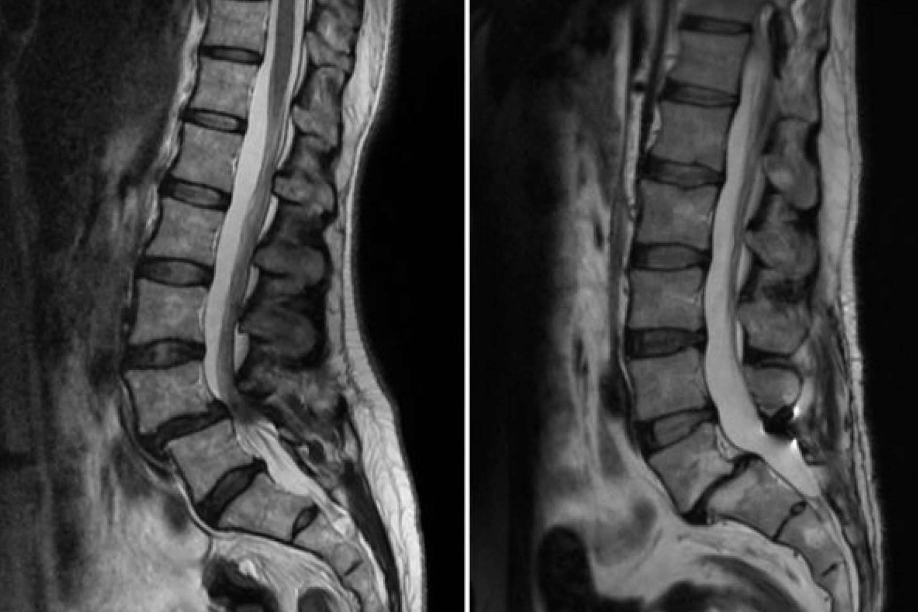 El Dr. Botella-Asunción habla sobre la Espondilolistesis Lumbar ...