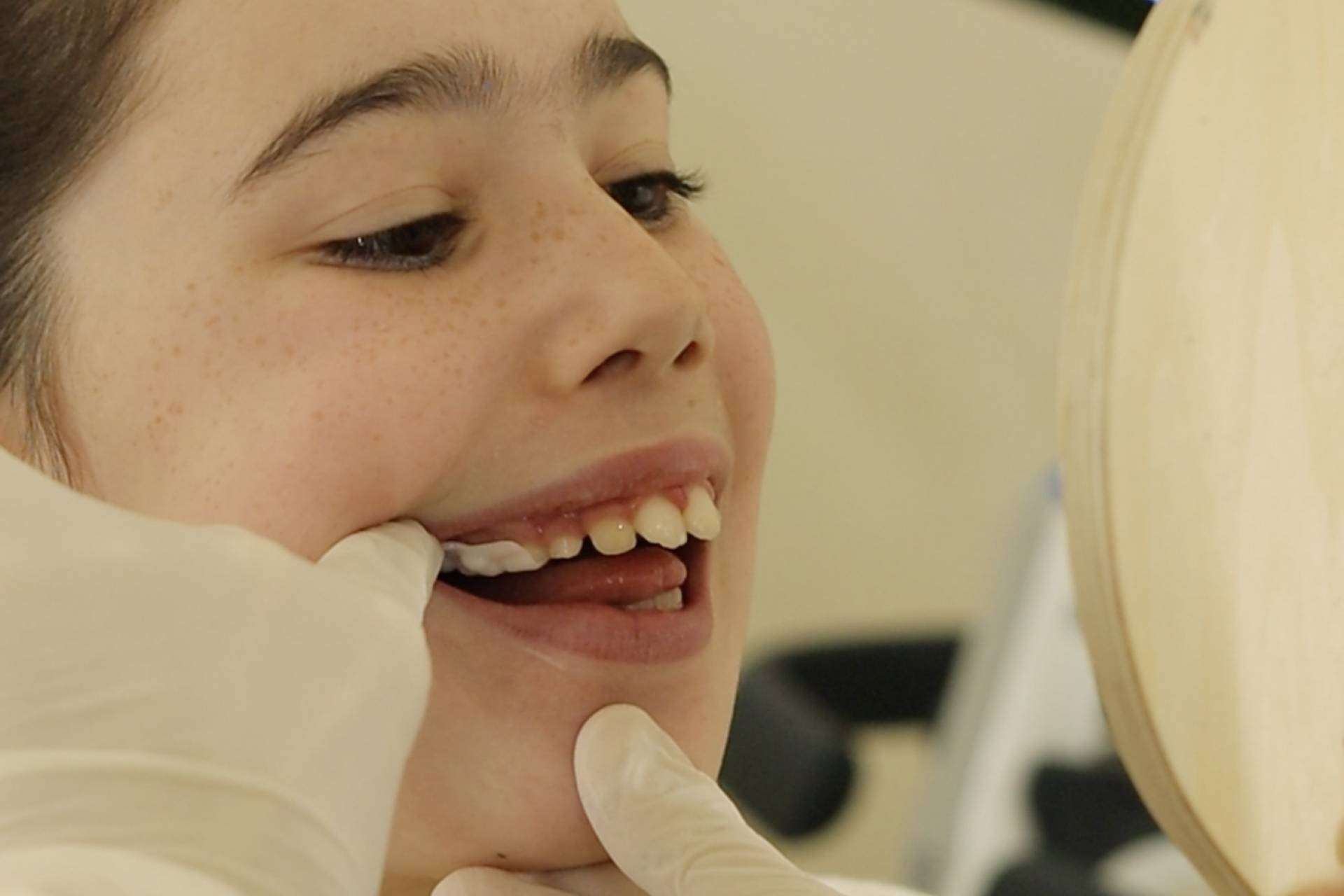 Smart Aligner Services da la bienvenida al Palatal Expander en su ...